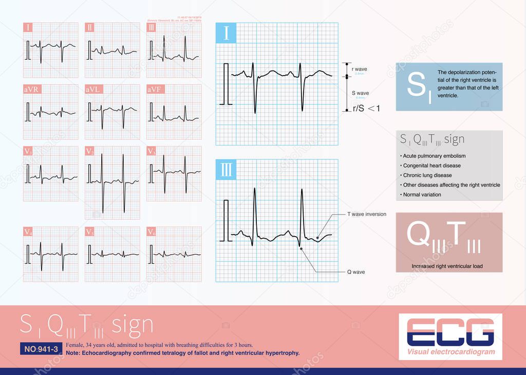 El signo SQT es un cambio electrocardiográfico de la cardiopatía ...