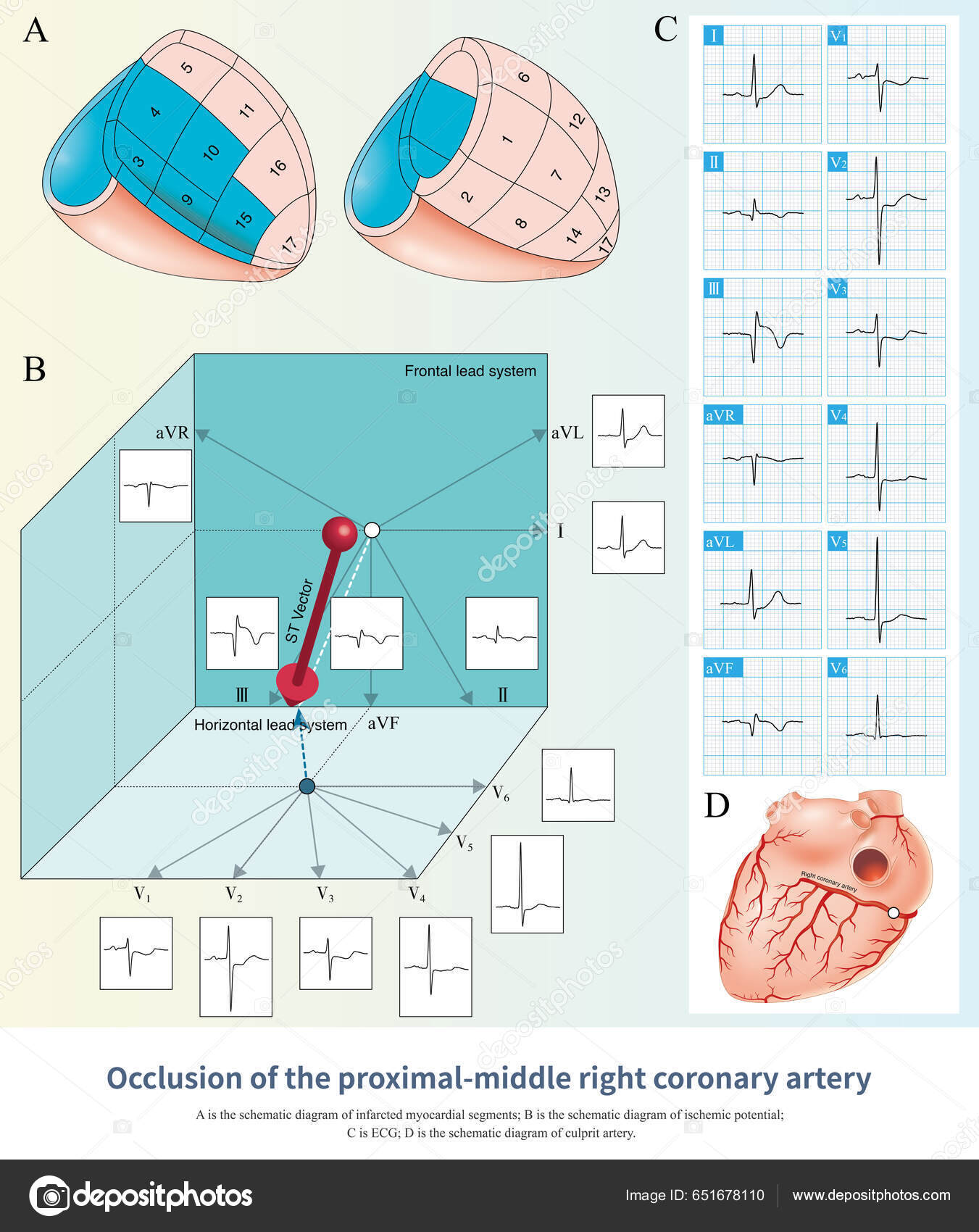 Proximal Middle Segment Right Coronary Artery Occluded Ischemic ...