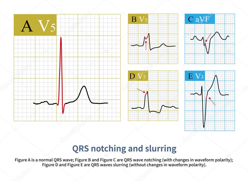 La despolarización ventricular normal produce ondas QRS suaves y agudas ...