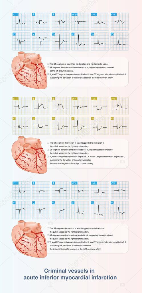 Tanto la arteria circunfleja izquierda como la oclusión de la arteria ...