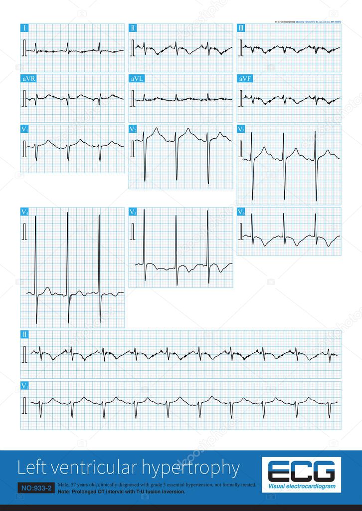 El ECG típico de la hipertrofia ventricular izquierda es el alto ...