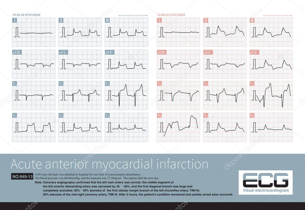 Paciente de 69 años con infarto agudo de miocardio, cuyo infarto afectó ...