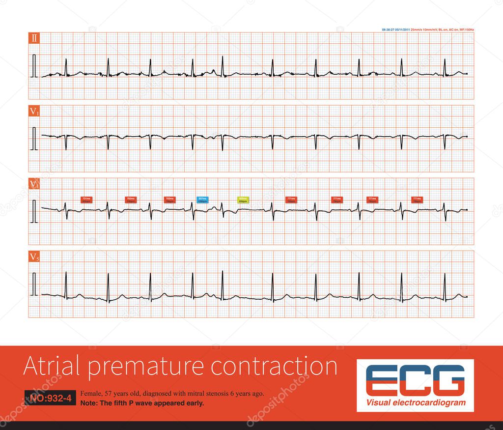 Paciente femenina de 57 años con estenosis mitral con ...