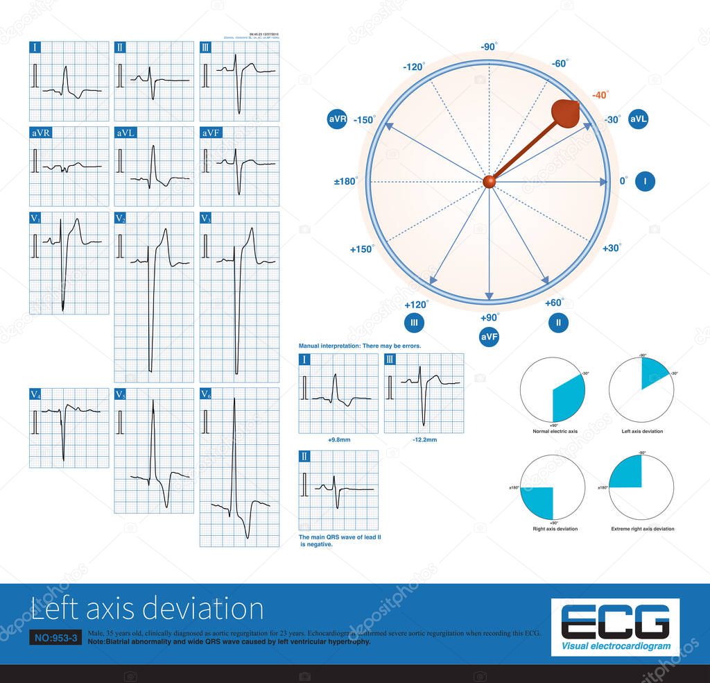 This is an electrocardiogram of left ventricular hypertrophy with left ...