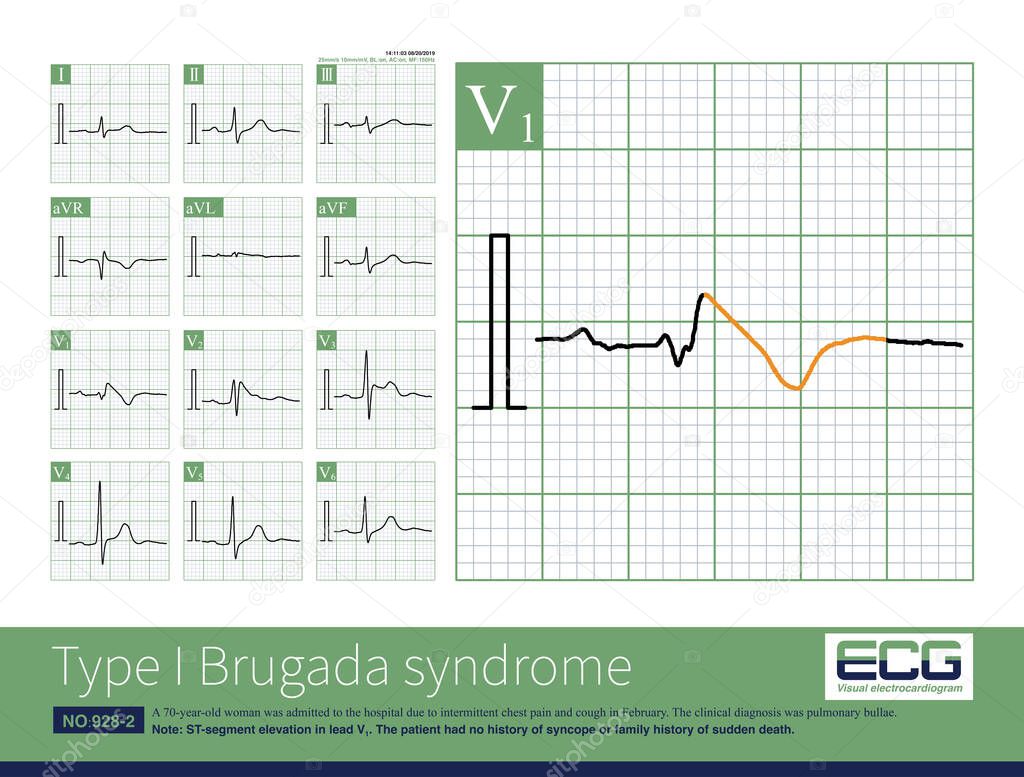 Mujer, 70 años, diagnosticada clínicamente con bullas pulmonares. El ...