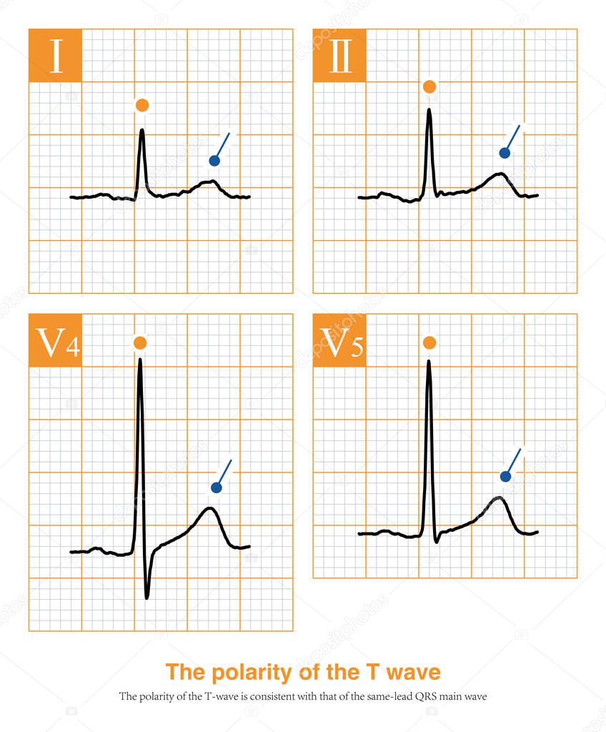 En el ECG de 12 derivaciones, en circunstancias normales, la polaridad ...