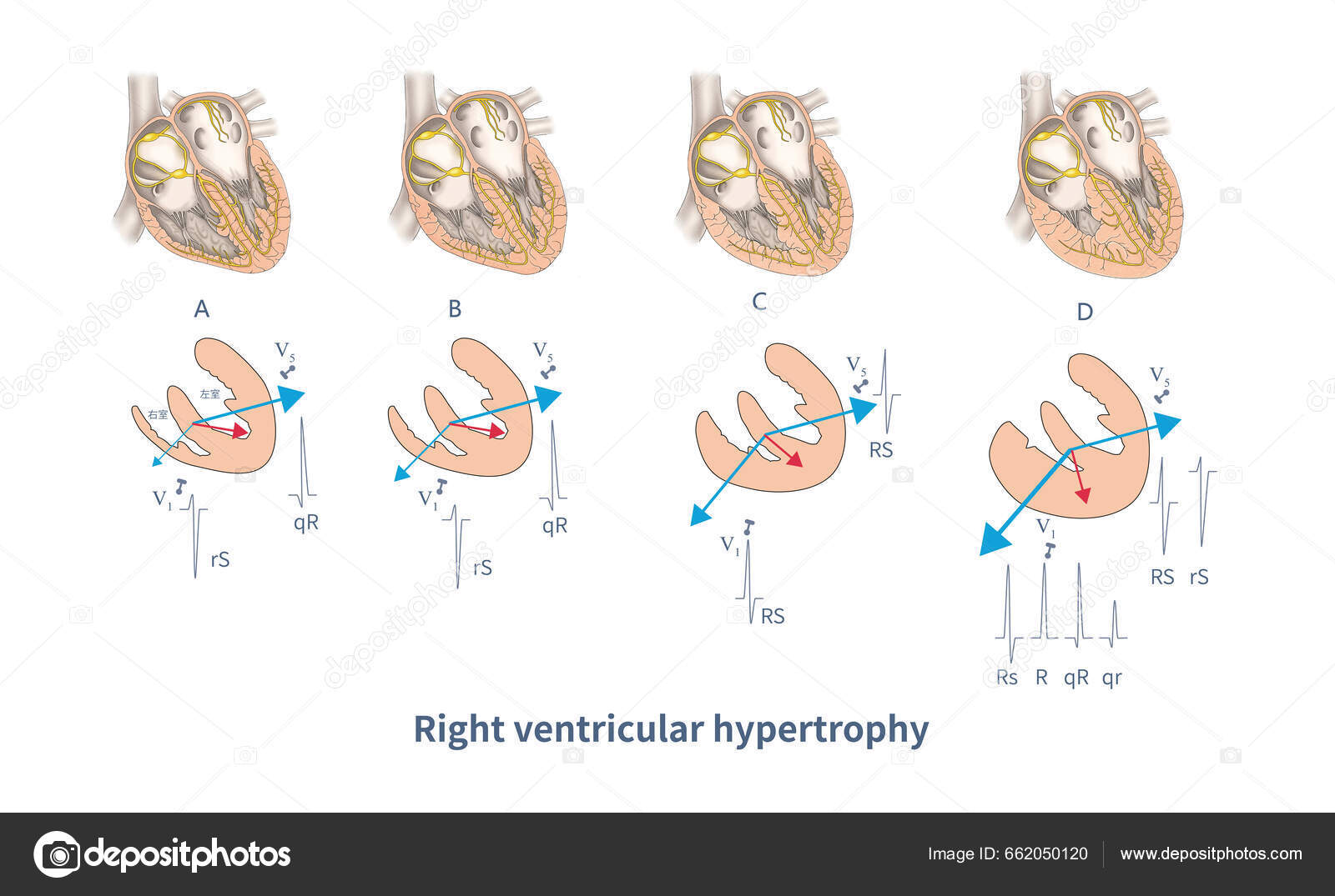 Ventricular Depolarization