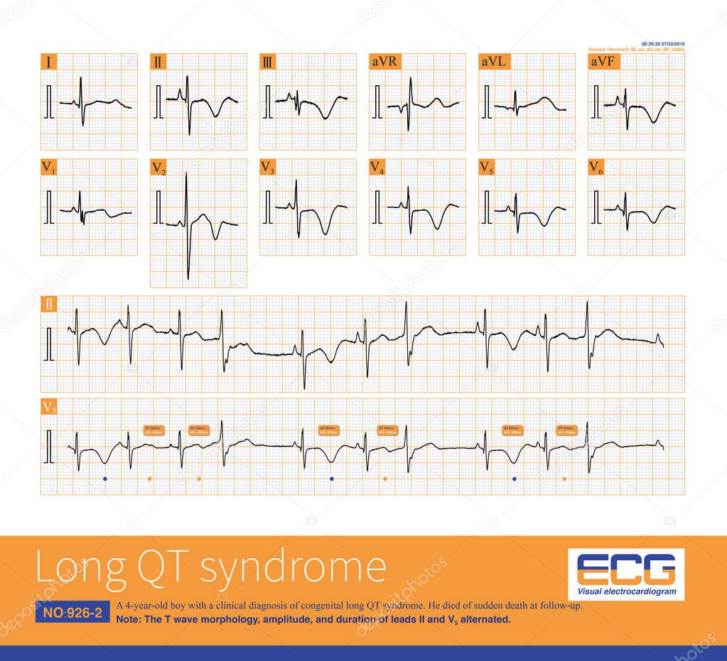 Niño de 4 años con diagnóstico clínico de síndrome de QT largo. No se ...