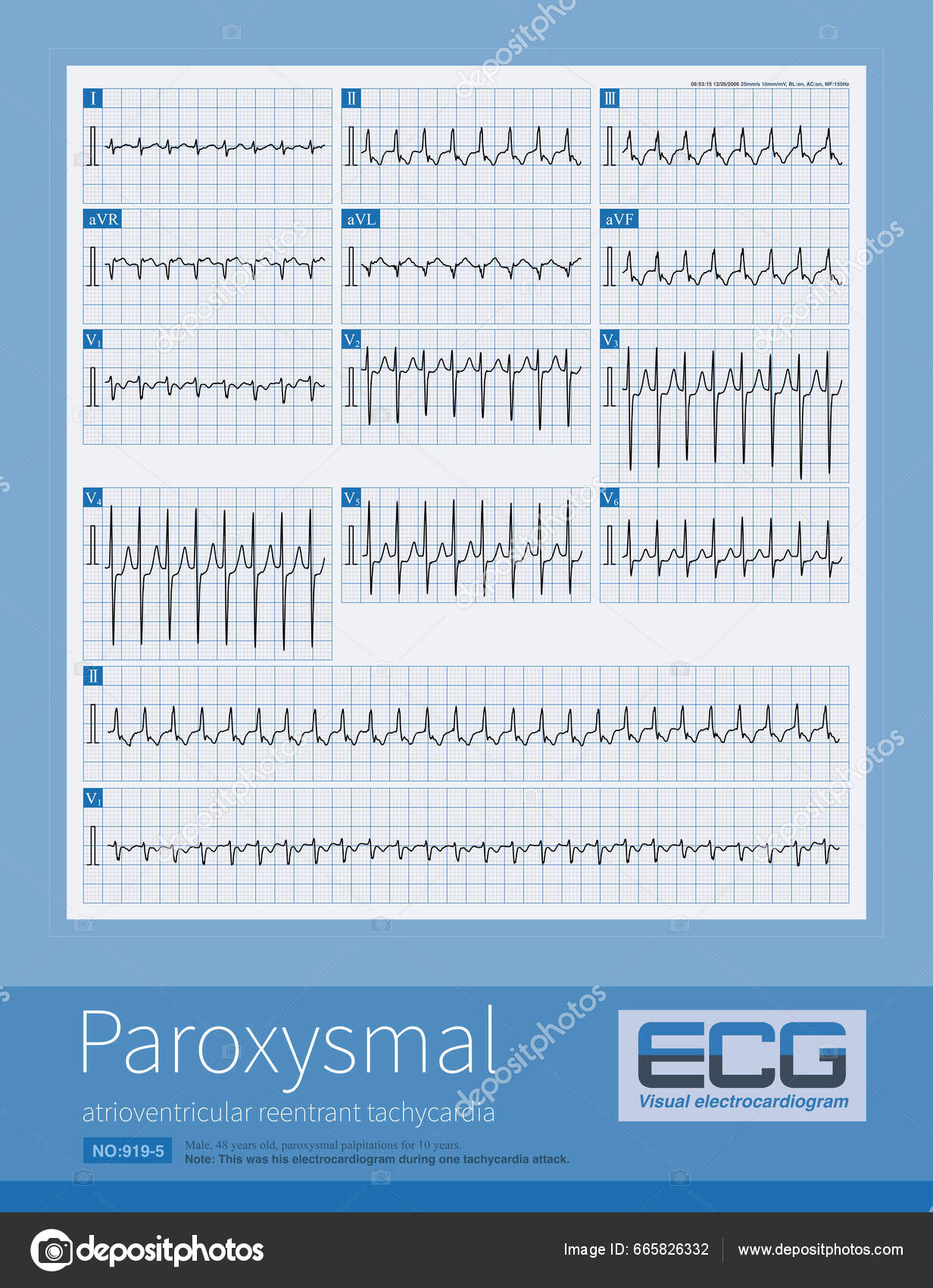 Paroxysmal Supraventricular Tachycardia Ecg