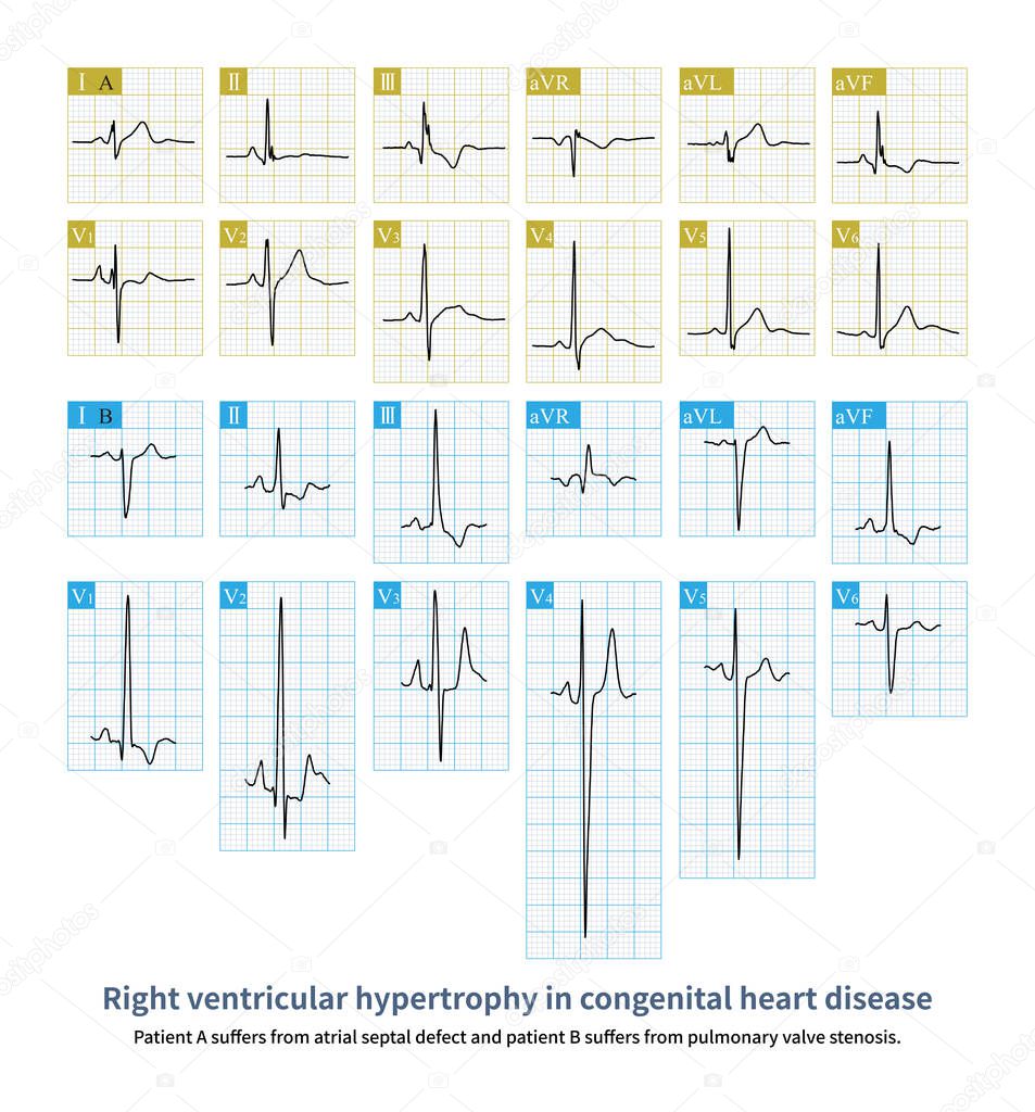 Diferentes pacientes con cardiopatía congénita tienen diferentes ...