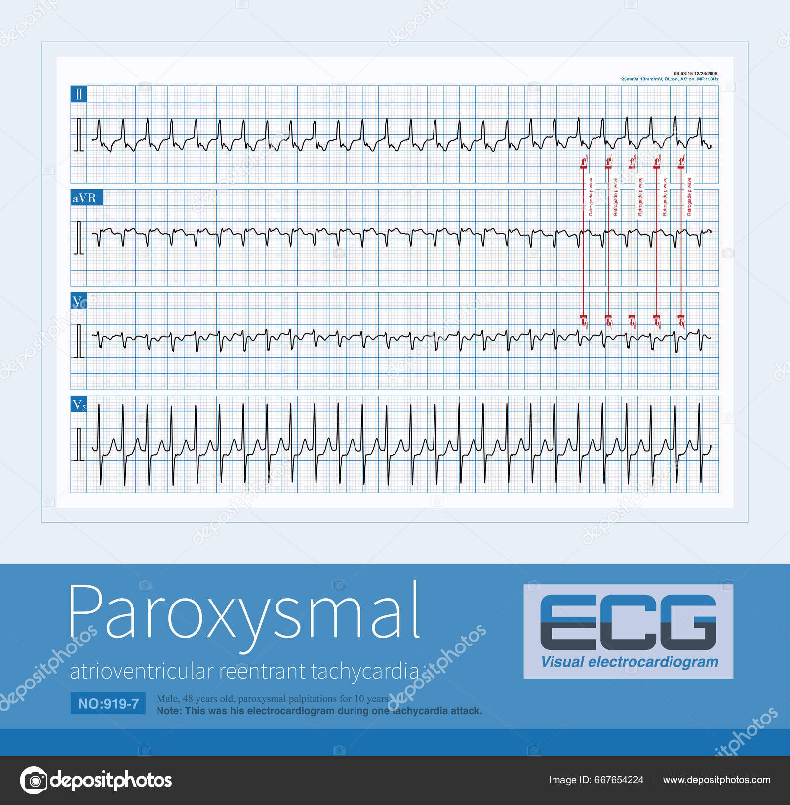 Paroxysmal Supraventricular Tachycardia