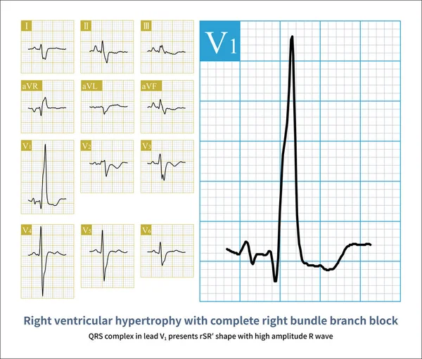 El complejo QRS en plomo V1 presenta forma de rSR con onda R de alta amplitud. El ...