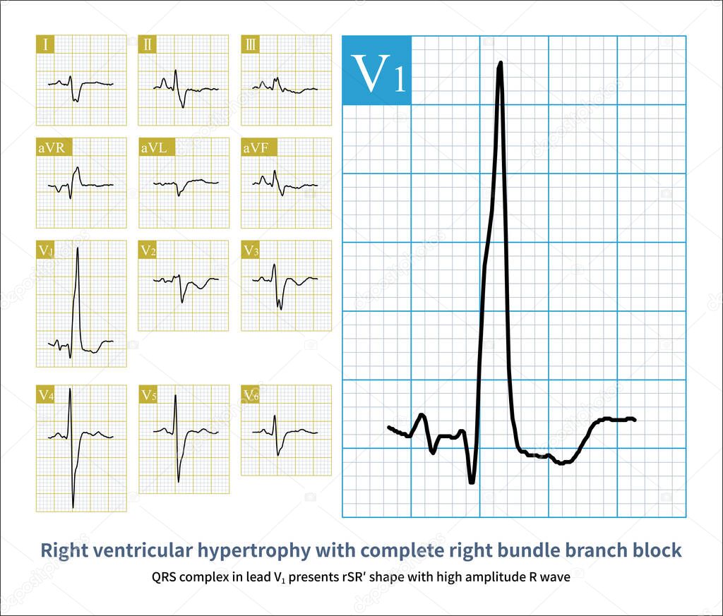 El complejo QRS en plomo V1 presenta forma de rSR con onda R de alta ...