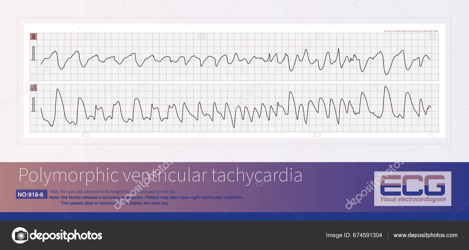 Polymorphic Ventricular Tachycardia