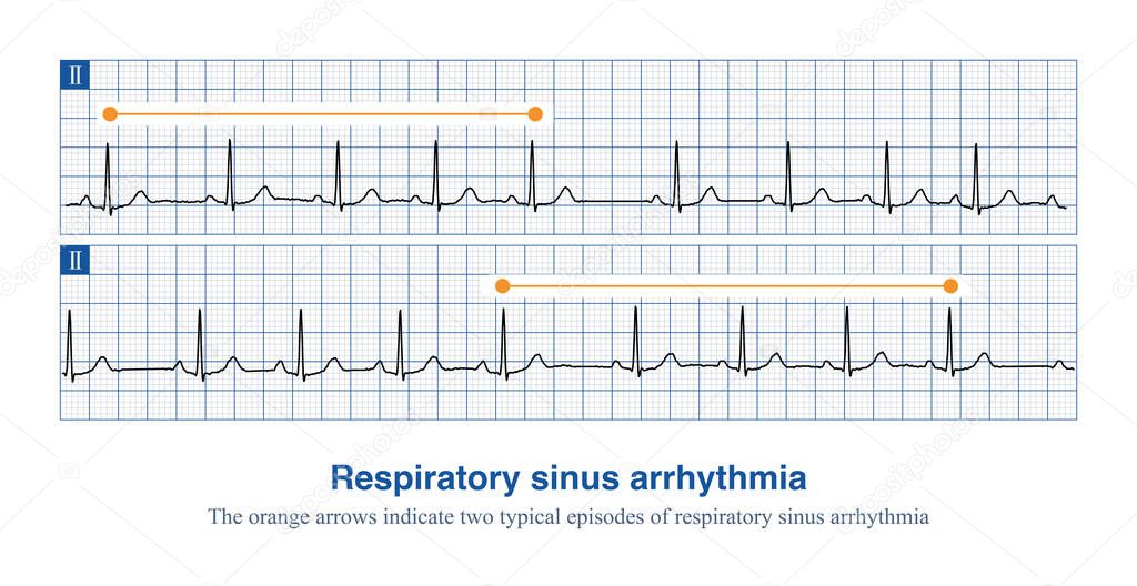 La arritmia sinusal respiratoria se diagnostica cuando la frecuencia ...