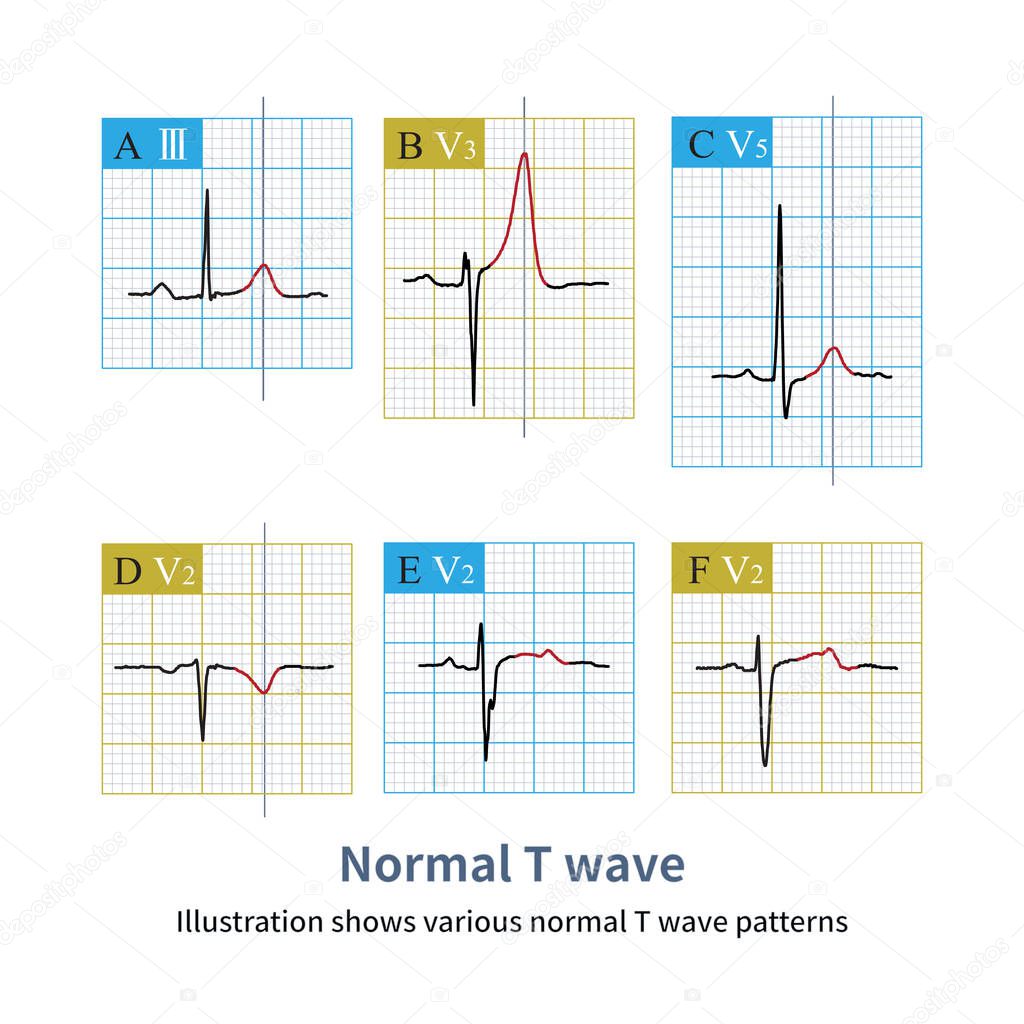 Hay muchas morfologías de las ondas T normales, y algunas son altas ...