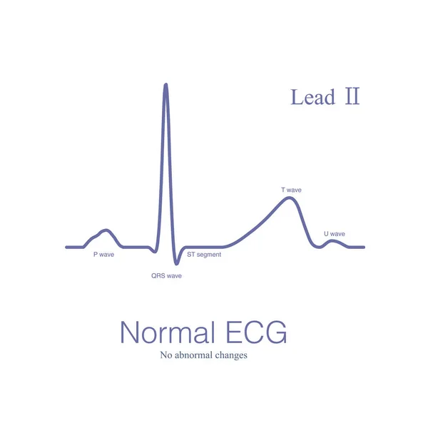 Un ECG normal es un ECG que no tiene ningún cambio anormal y se puede ...