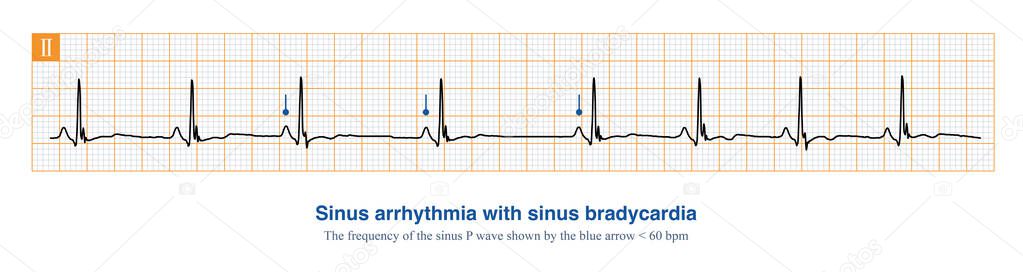 En la práctica clínica, la arritmia sinusal a menudo ocurre junto con ...