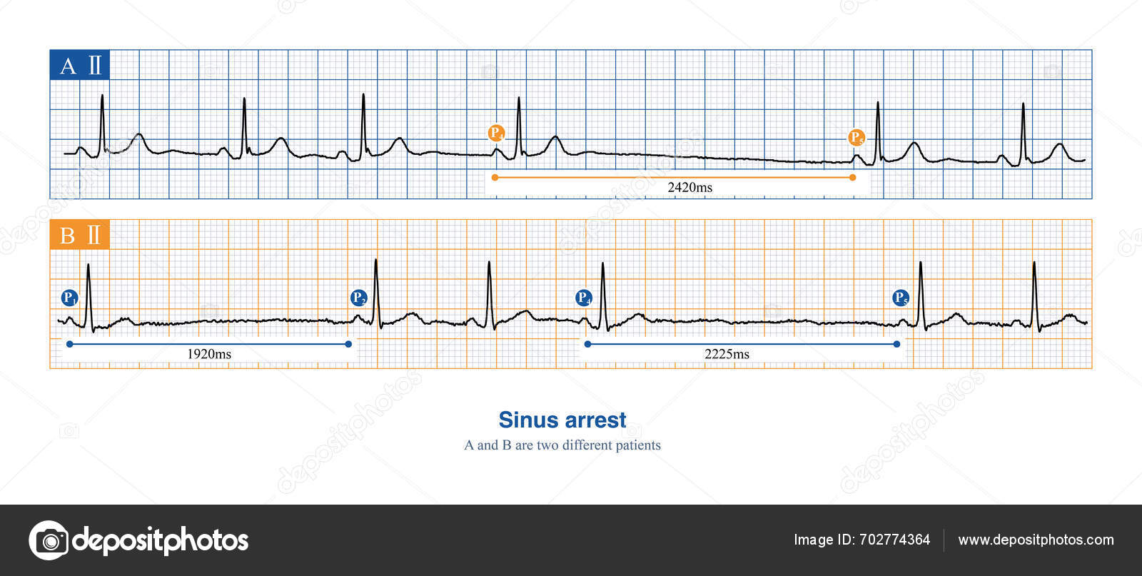 Sinus Arrest Occurs Electrocardiogram Show Long Interval Which ...