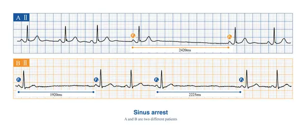 Fotos de Bradicardia sinusal, Imagens de Bradicardia sinusal sem ...