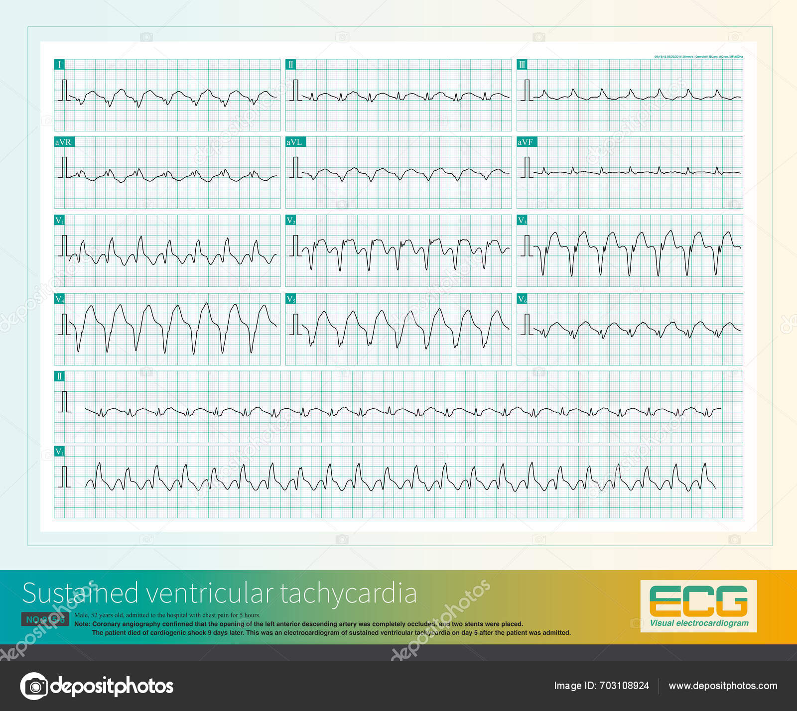 Acute Myocardial Infarction High Incidence Ventricular Tachycardia ...