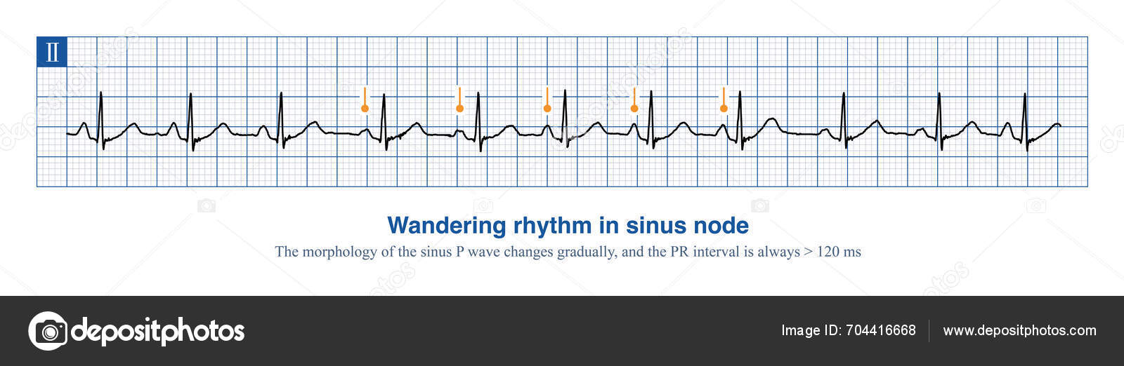 Dominant Pacemaker Sinus Node Changes Sinus Node Morphology Frequency ... Dominant Pacemaker Sinus Node Changes Sinus Node Morphology Frequency ...