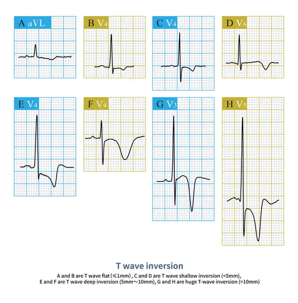 La inversi n de la onda T es un fen meno com n del ECG, que puede ser un fen meno normal del ECG ...