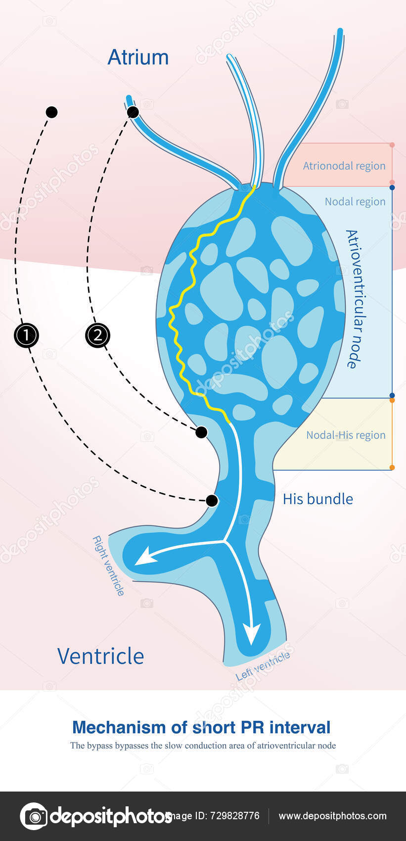 Some Accessory Pathways Directly Connect Atrium Lower Part ...