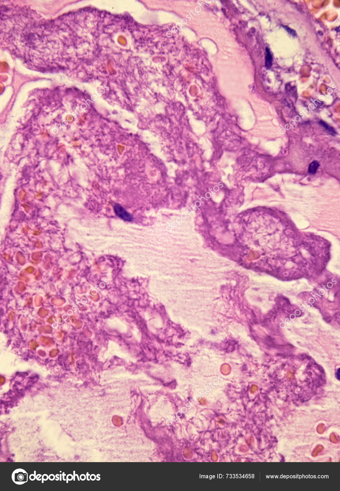 Photo Shows Pink Mucinous Matrix Atrial Myxoma Magnify 1000X — Stock ...