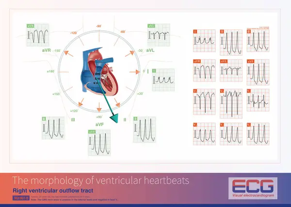 Idiopathic ventricular tachycardia Stock Photos, Royalty Free ...