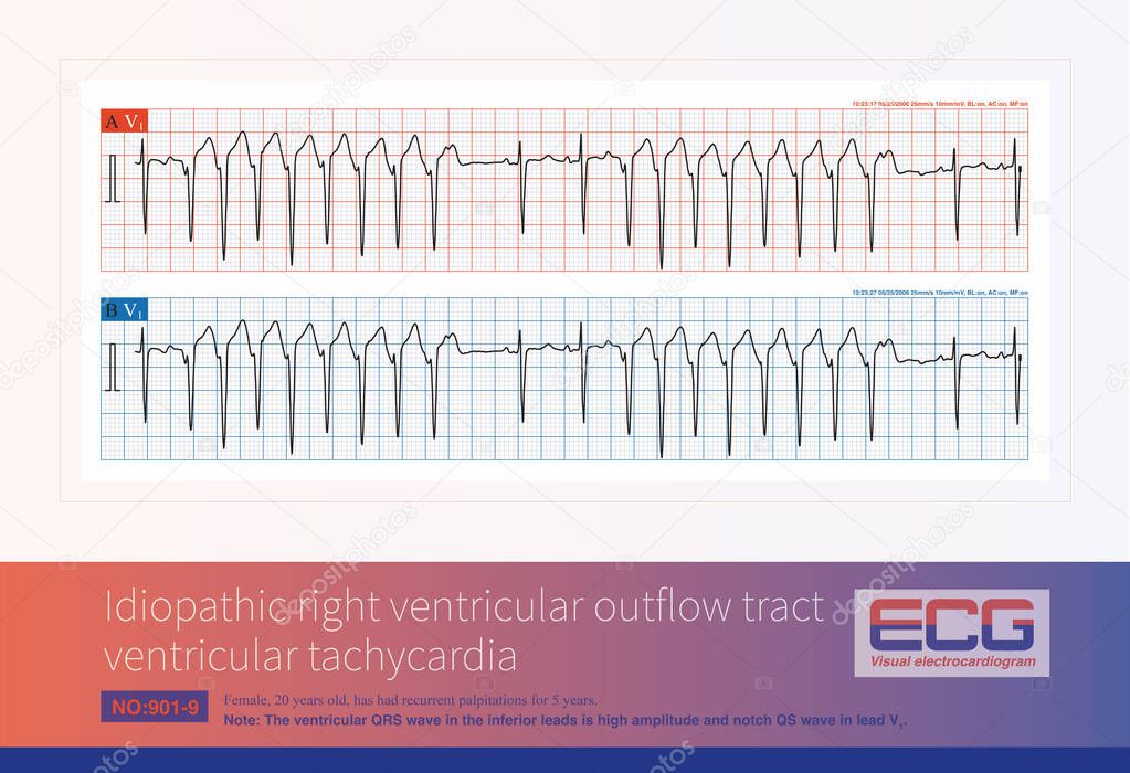 La taquicardia ventricular idiopática originada en el tracto de salida del ventrículo derecho es ...
