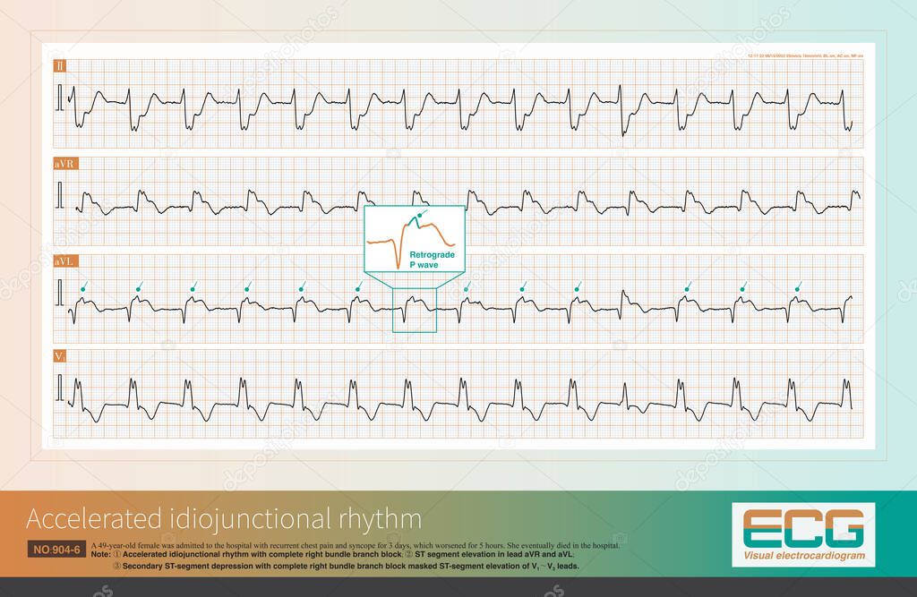En un ritmo QRS amplio, la naturaleza de la onda P se puede observar en ...