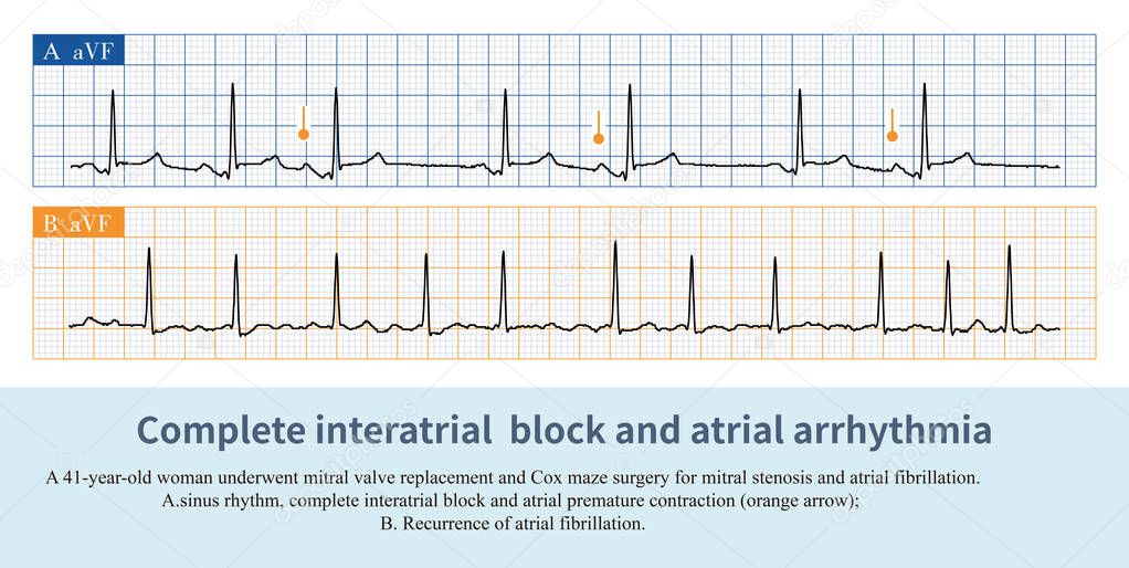 Las características ECG del bloqueo interauricular completo son ondas P ...