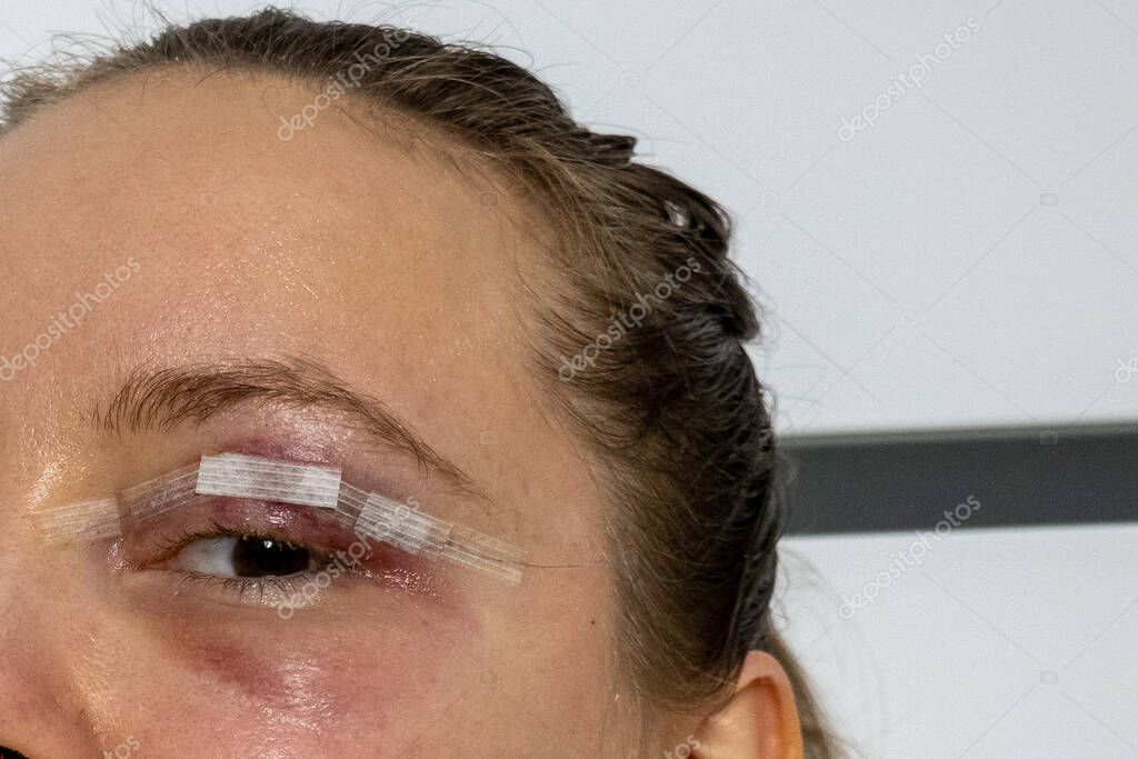 cerrar los ojos de las mujeres después de la cirugía plástica ...