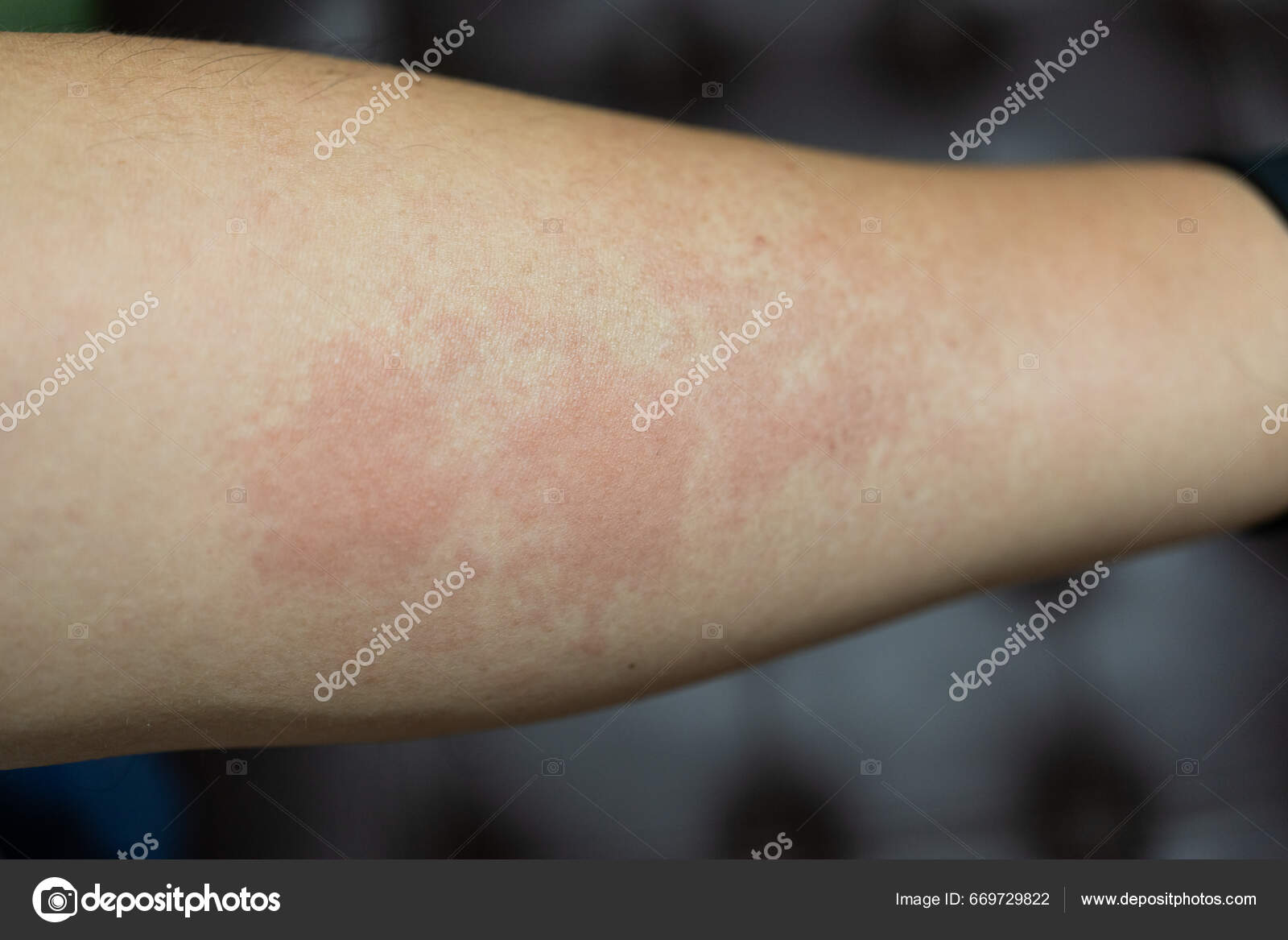 Erupción Alérgica Dermatitis Eccema Piel Del Paciente Mano Rascarse ...