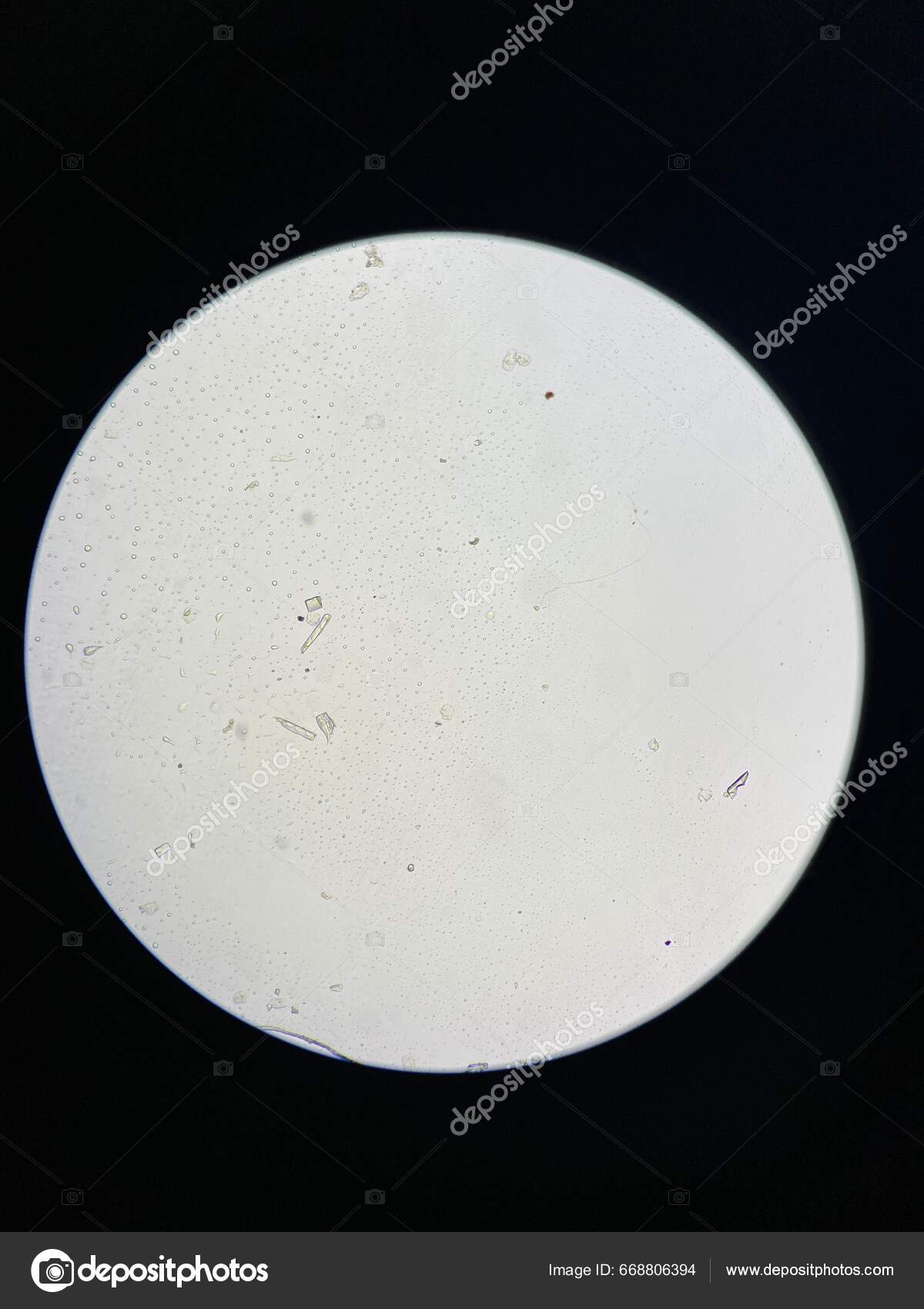 Microscopic View Struvite Crystals Urinary Sediment Magnesium Ammonium ...
