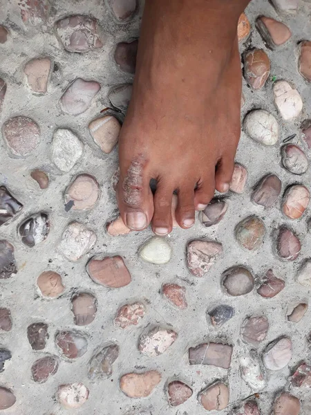 Psoriasis eczema dermatitis on the big toe which makes the sufferer's ...