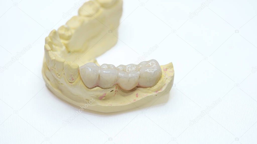 Este es un modelo de impresión de los dientes del paciente hechos de ...
