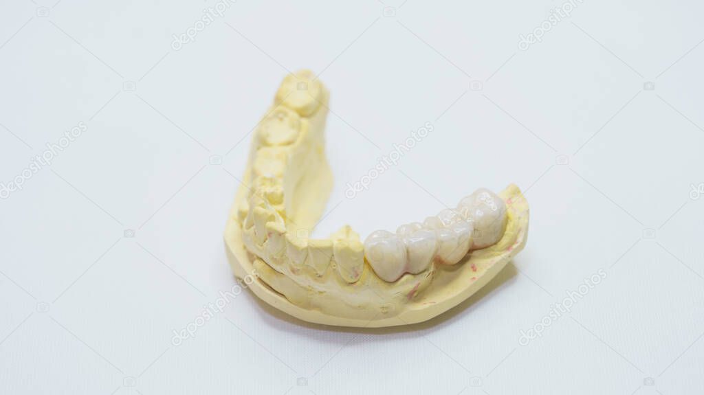 Este es un modelo de impresión de los dientes del paciente hechos de ...