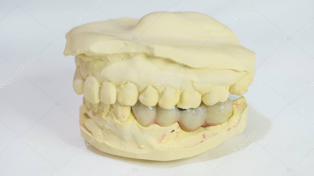 Este es un modelo de impresión de los dientes del paciente hechos de ...