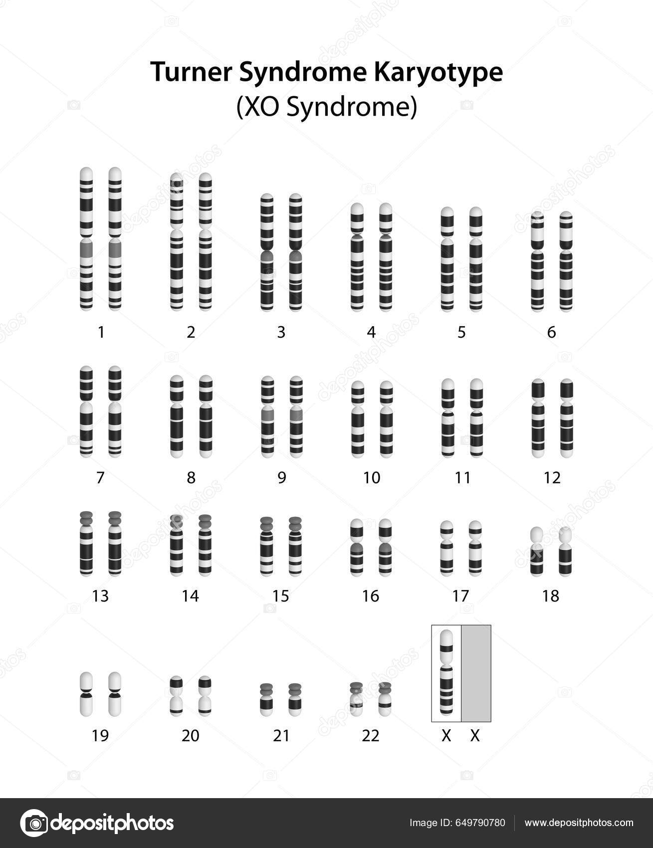 Turner Syndrome Male Karyotype