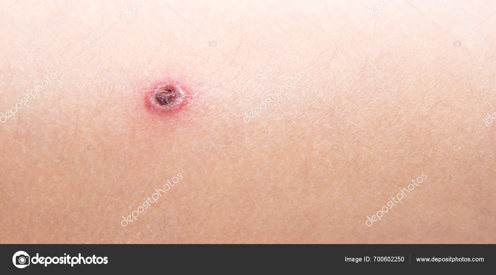 Child Has Spotted Red Pimples Blistering Rash Chickenpox Varicella ...