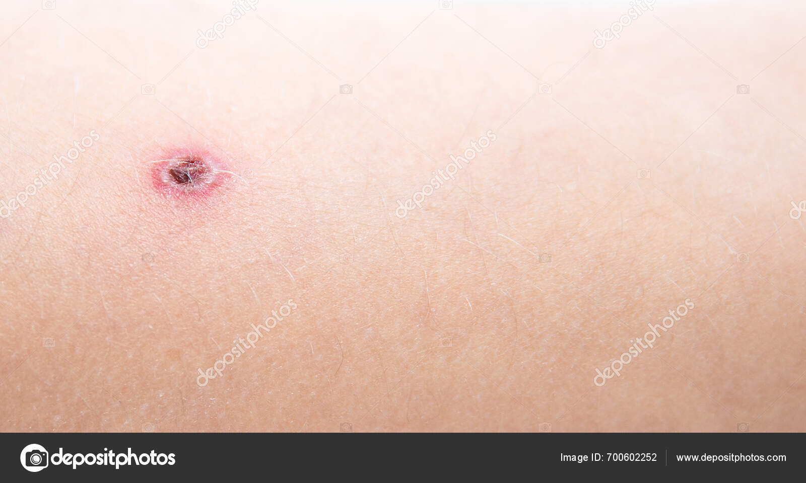 Child Has Spotted Red Pimples Blistering Rash Chickenpox Varicella ...