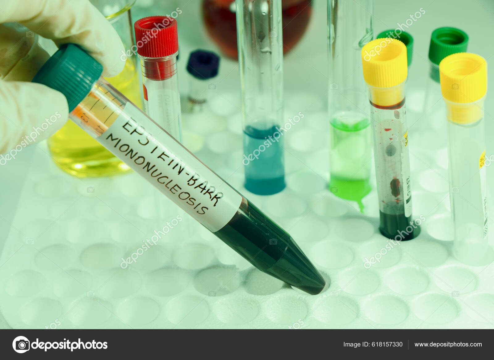 Mononucleosis Epstein Barr Virus Blood Test Sample Lab Stock Photo by ...