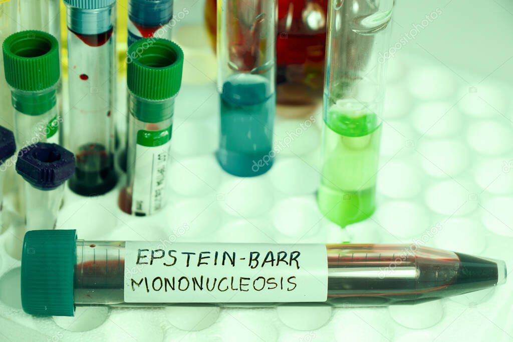 "Mononucleosis and Epstein-barr virus blood test sample in lab" 2023