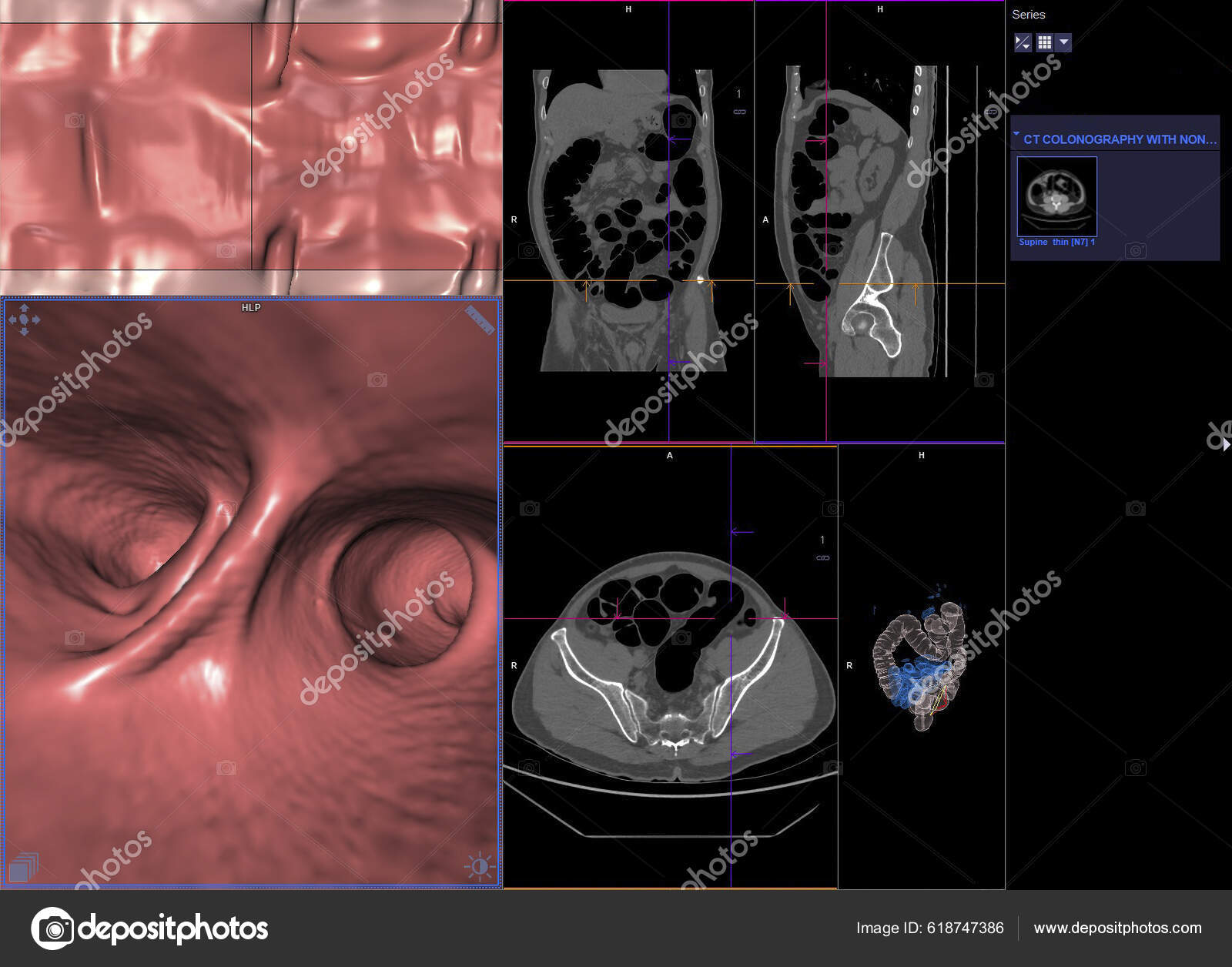 Colonography Scan Colon Axial View Coronal View Rendering Image Stock ...