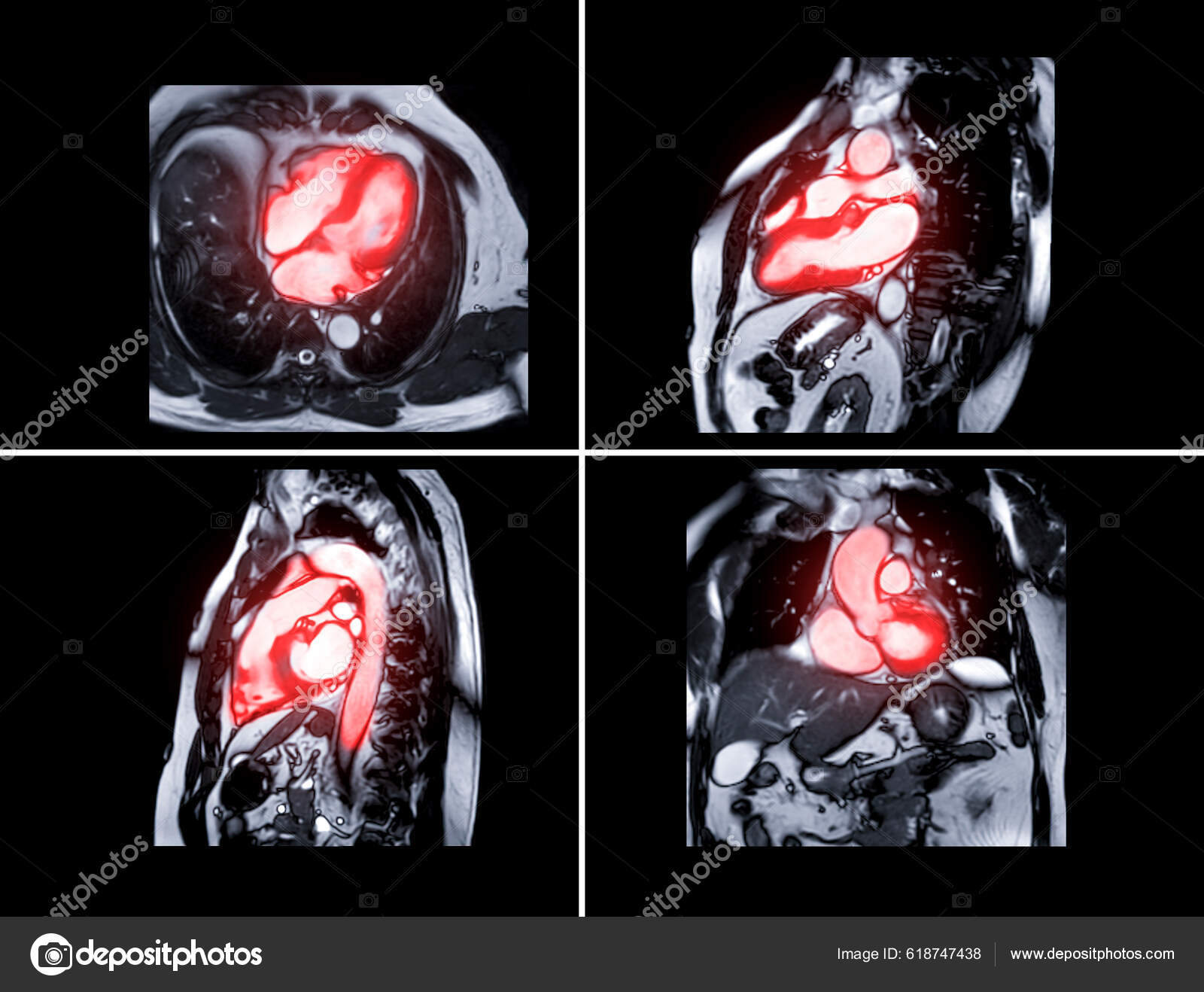 Collection Mri Heart Cardiac Mri Magnetic Resonance Imaging Heart Diagnosis Stock Photo by ©YAY ...