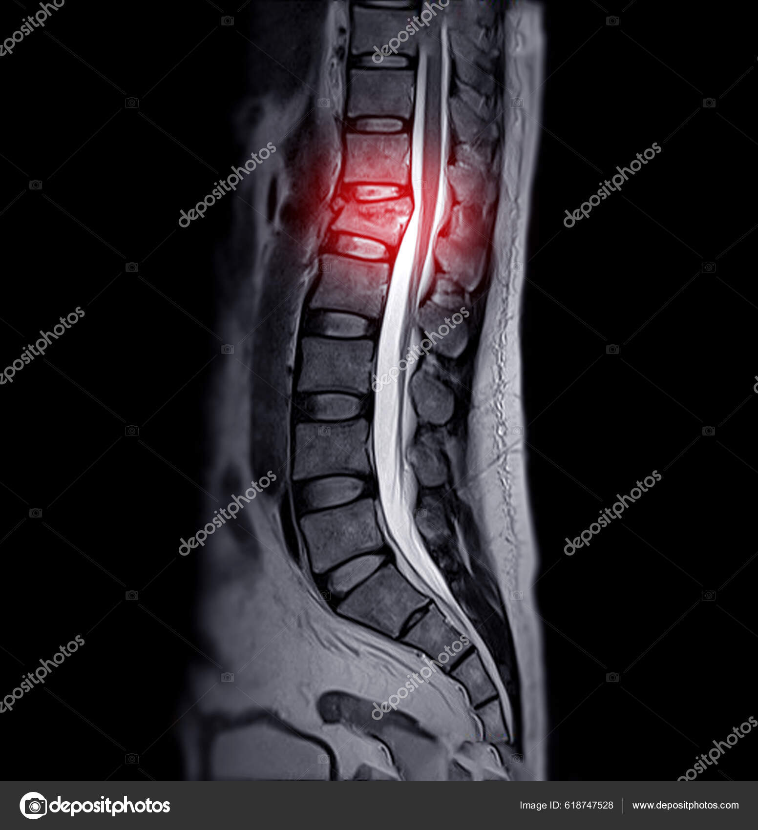 Mri Lambosacral Spine Spine Sagittal Plane Showing Herniated Disc Spine ...