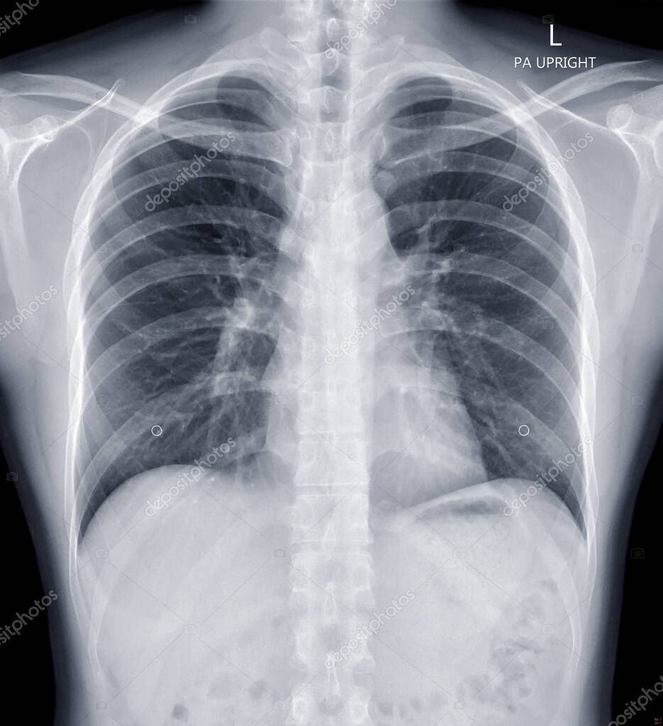 "Radiografía de tórax o imagen de rayos X del pecho humano" 2023