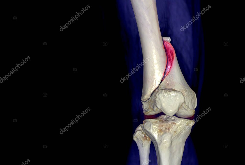 "CT rodilla 3D representación imagen AP vista aislada sobre fondo negro ...